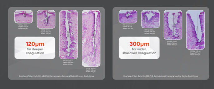 eCO2 - Cynosure Lutronic EMEA eCO2 Plus™ Laser | Cynosure Lutronic